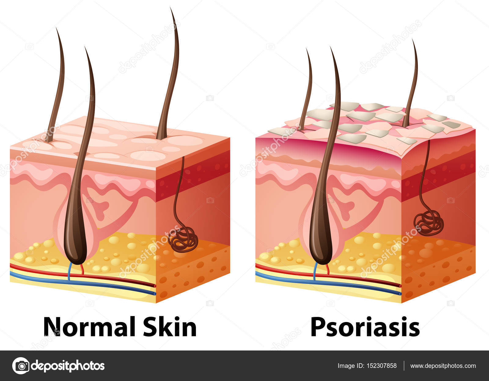 Human skin diagram with normal and psoriasis Stock Illustration by ...
