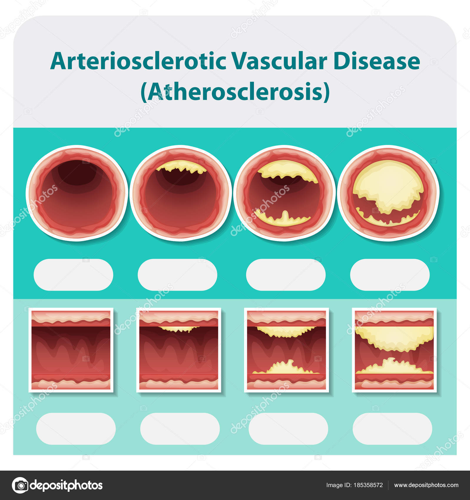 Diagram showing arteriosclerotic veascular disease Stock Vector Image ...
