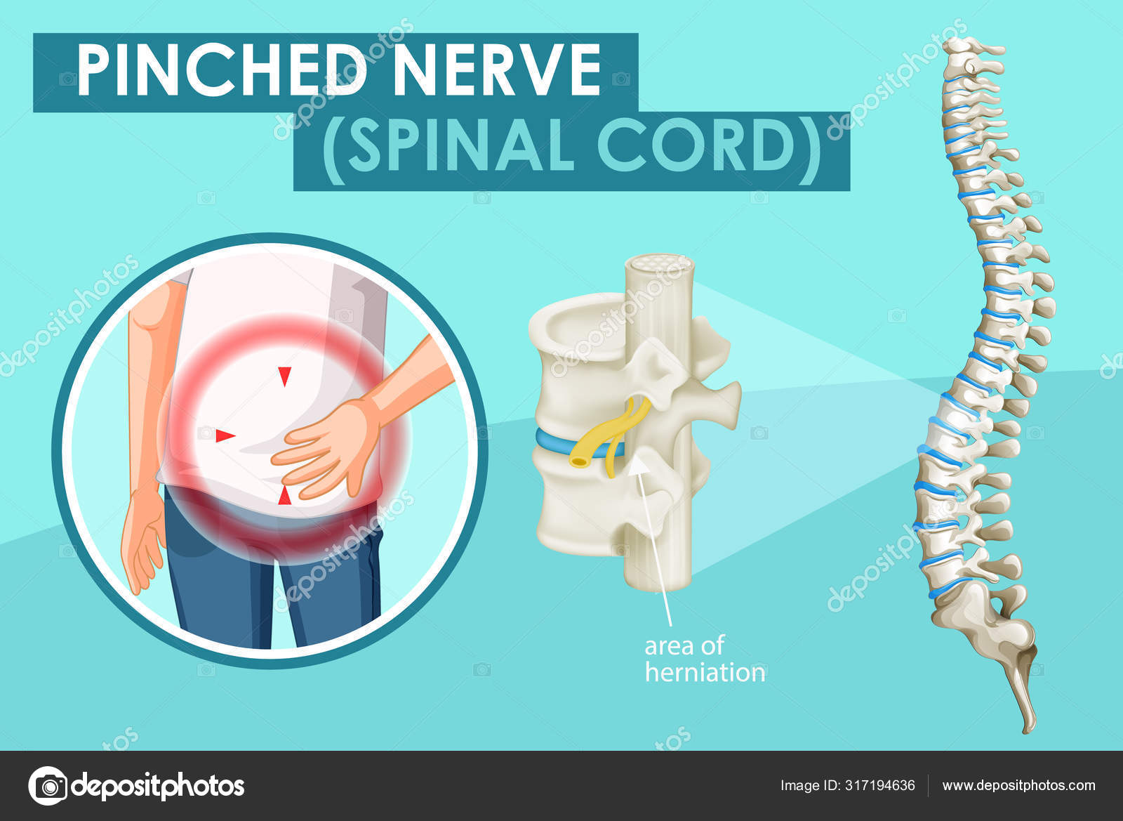 Diagram Showing Pinched Nerve In Human Stock Vector By ©blueringmedia 317194636