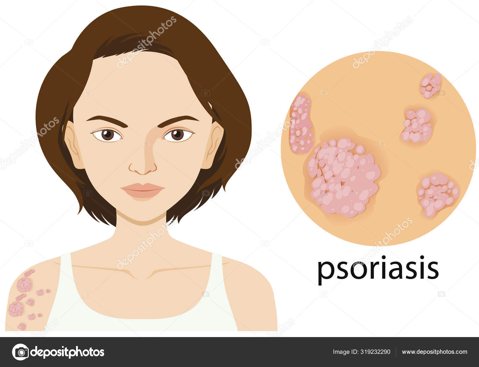 Woman with psoriasis on poster Stock Vector Image by ©blueringmedia ...