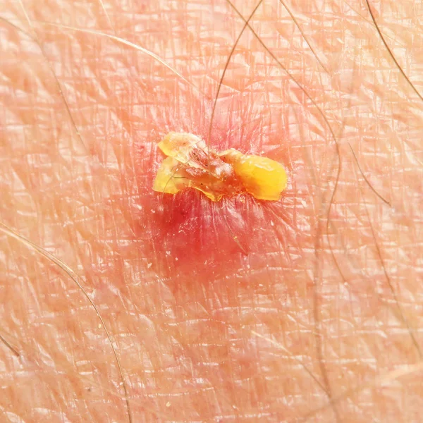 Bug bite Stock Photos, Royalty Free Bug bite Images | Depositphotos