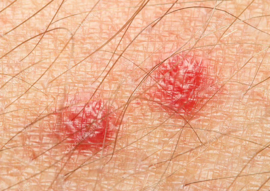 Marcas, picaduras o llagas en la piel humana 2024