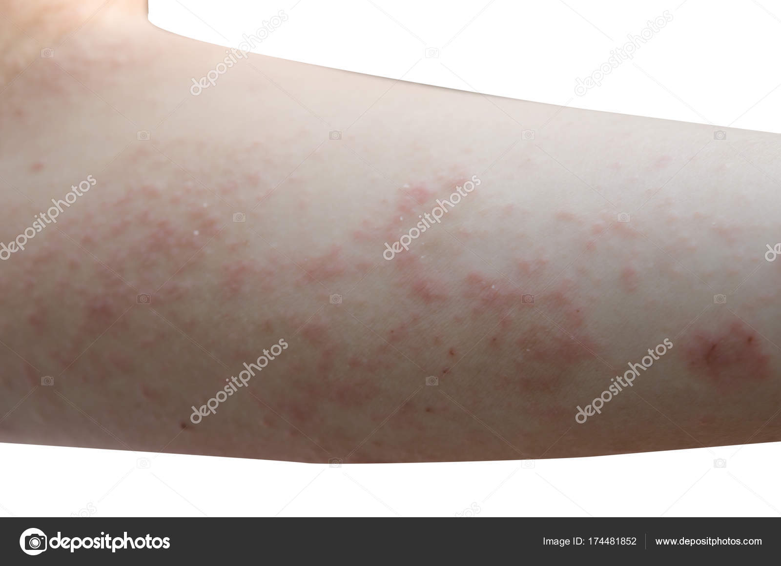 Erupción roja en los brazos: fotografía de stock © aoo8449 #174481852 ...
