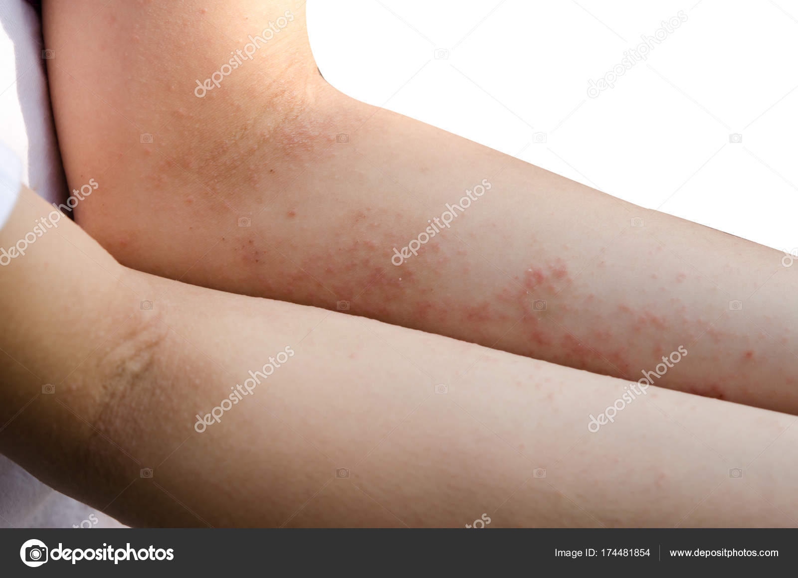 Erupción roja en los brazos: fotografía de stock © aoo8449 #174481854 ...