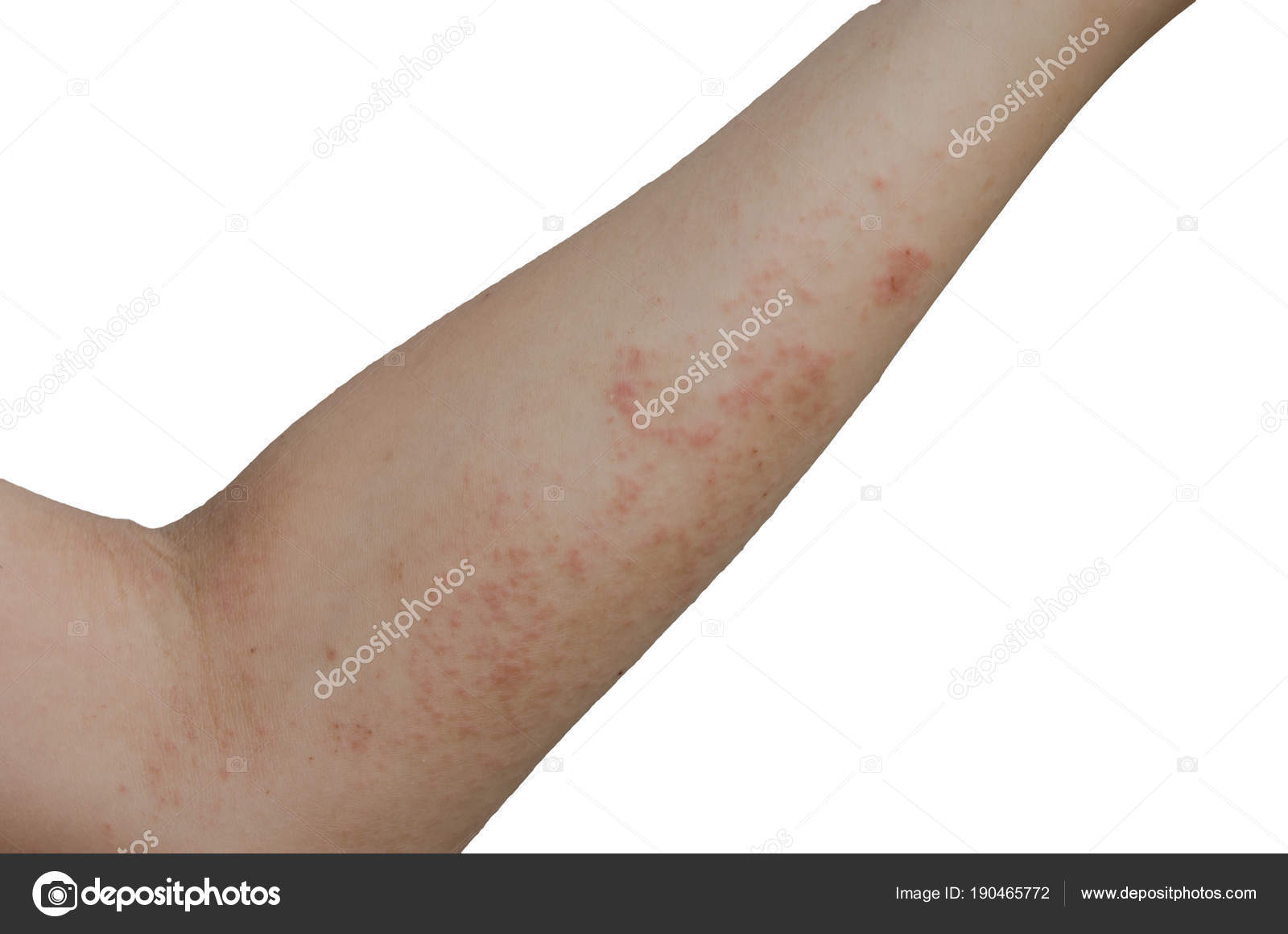 Red rash on the arms — Stock Photo © aoo8449 #190465772