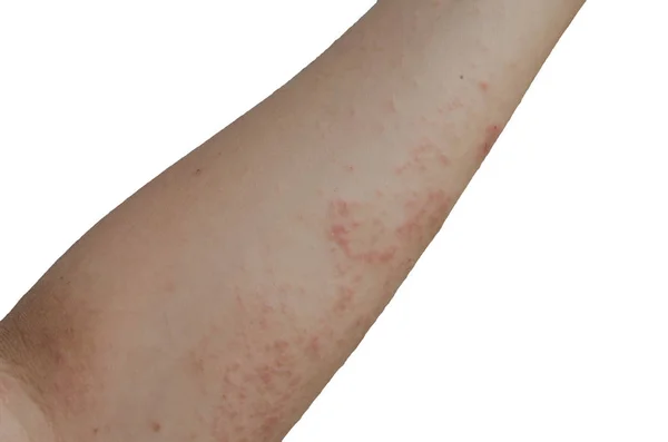 Red rash on the arms Stock Photo by ©aoo8449 178535872