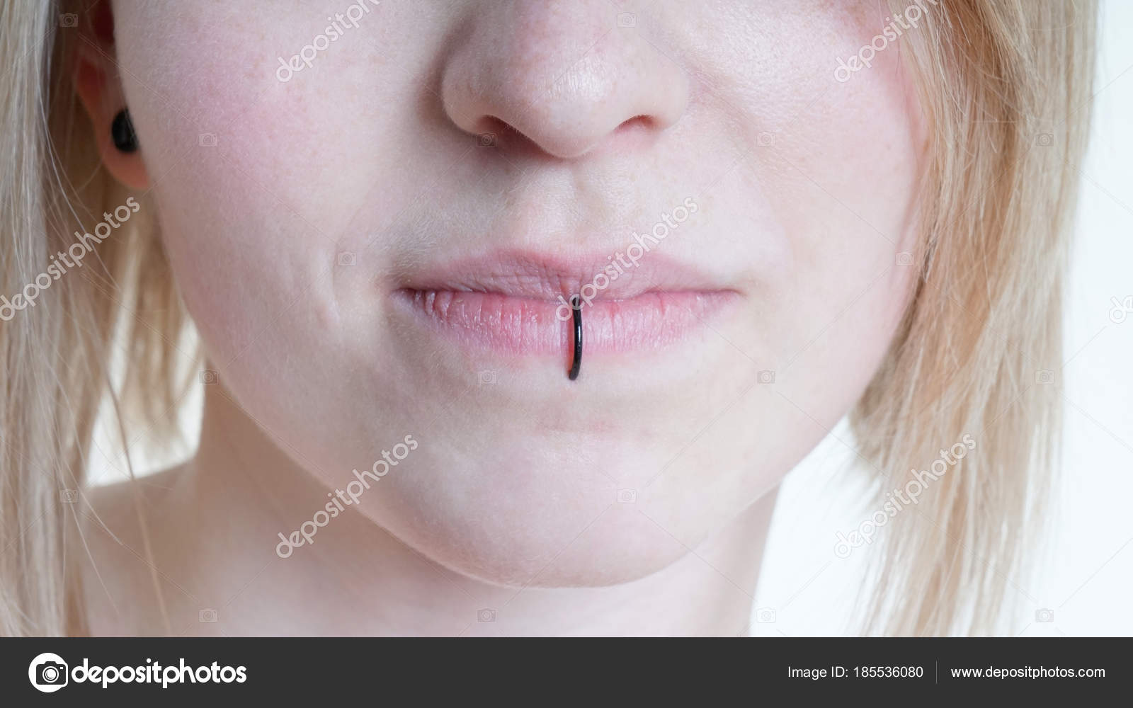 Vertical Labret Piercing Infection