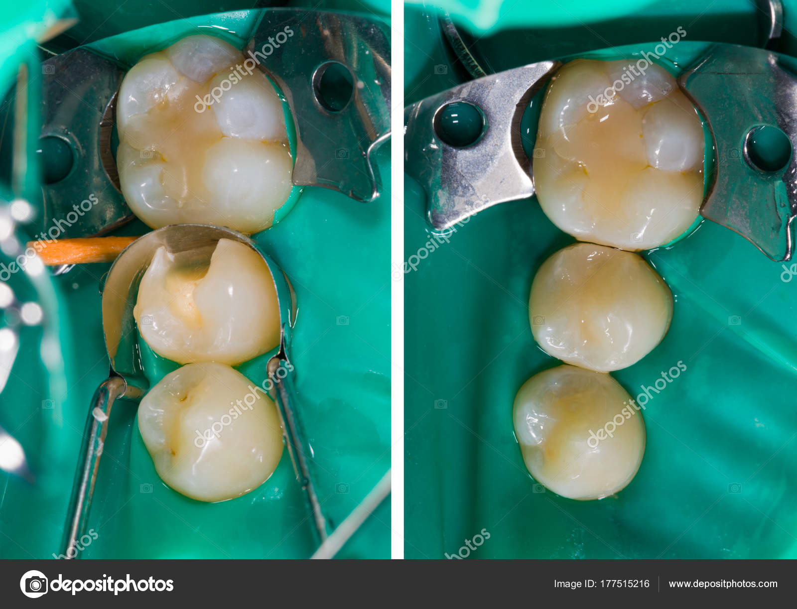 Dental filling comparison, before - after — Stock Photo © Lighthunter ...