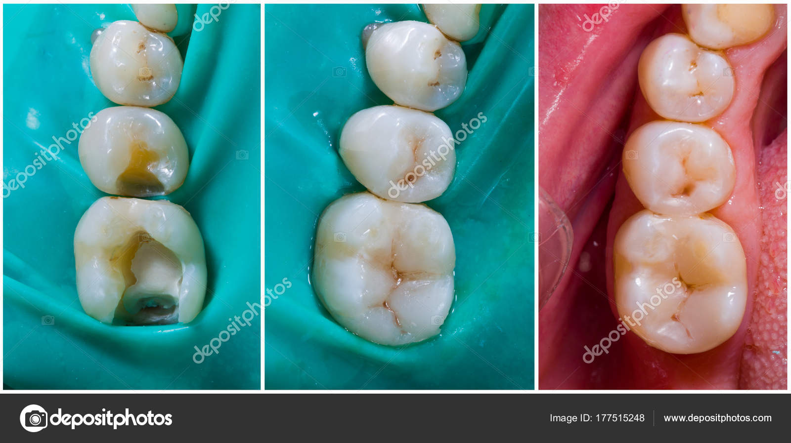 Upper molar and premolar aesthetic filling — Stock Photo © Lighthunter ...
