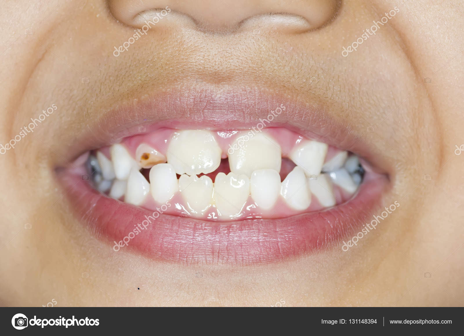 Asian kids smile with decayed teeth — Stock Photo © mrfiza #131148394