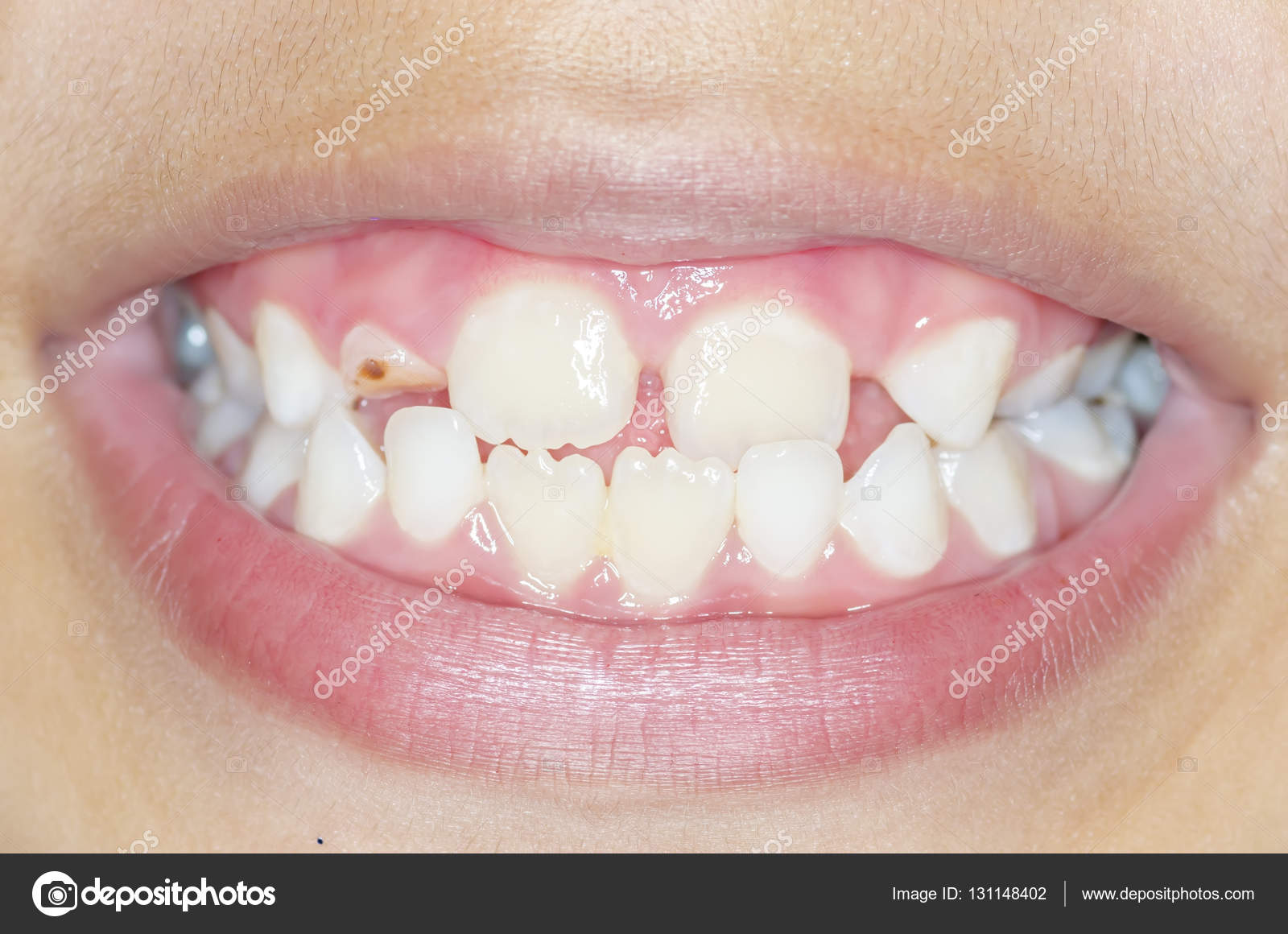 Asian kids smile with decayed teeth — Stock Photo © mrfiza #131148402