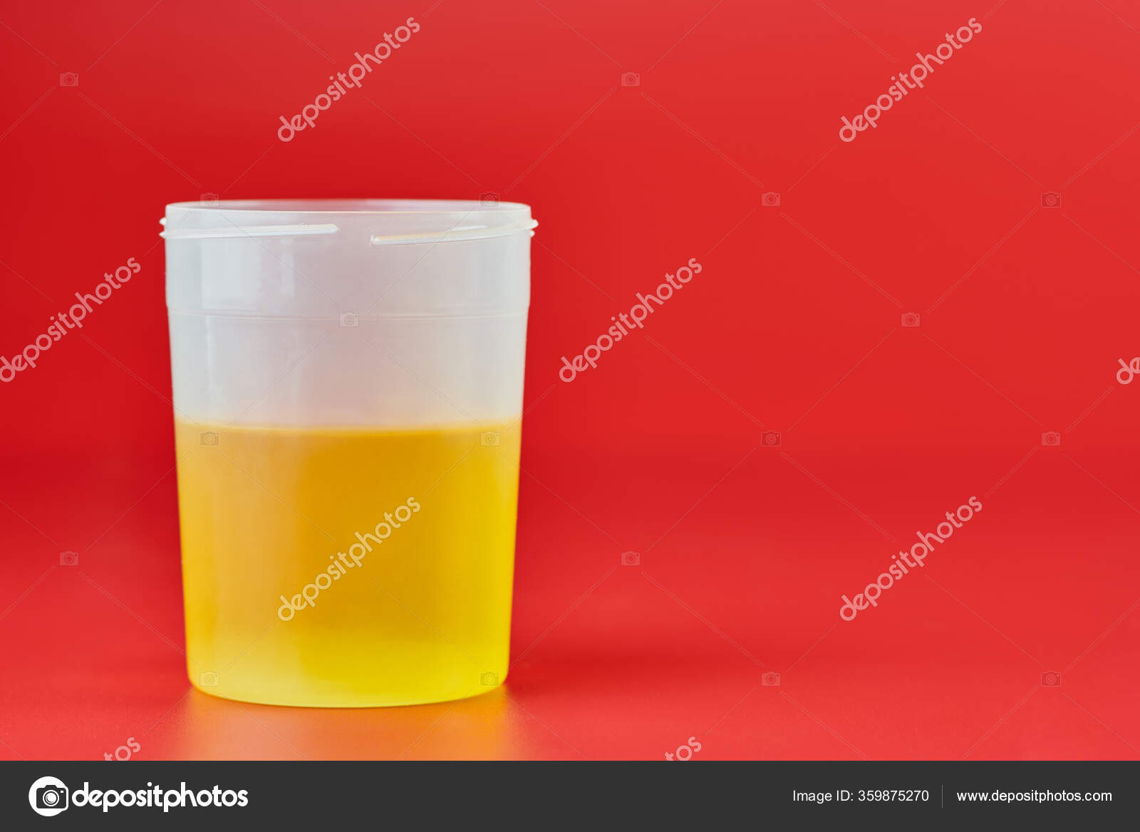 Fotos de Análisis Orina Para Urolitiasis Recipiente Muestras Orina Para ...