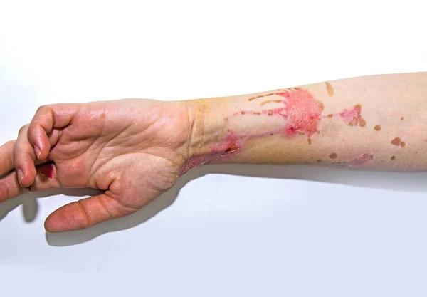 Erythema arm Stock Photos, Royalty Free Erythema arm Images | Depositphotos