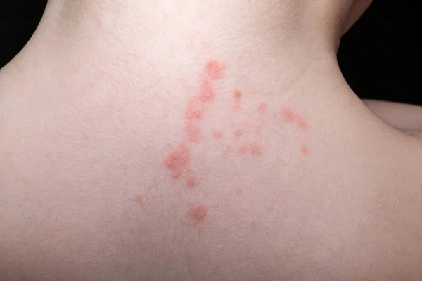 Rashes On Back