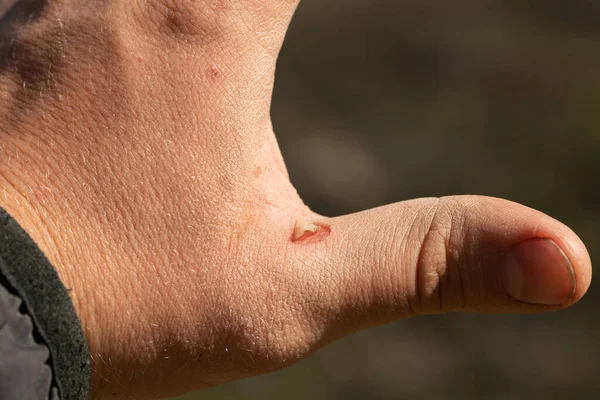 Midge bite Stock Photos, Royalty Free Midge bite Images | Depositphotos