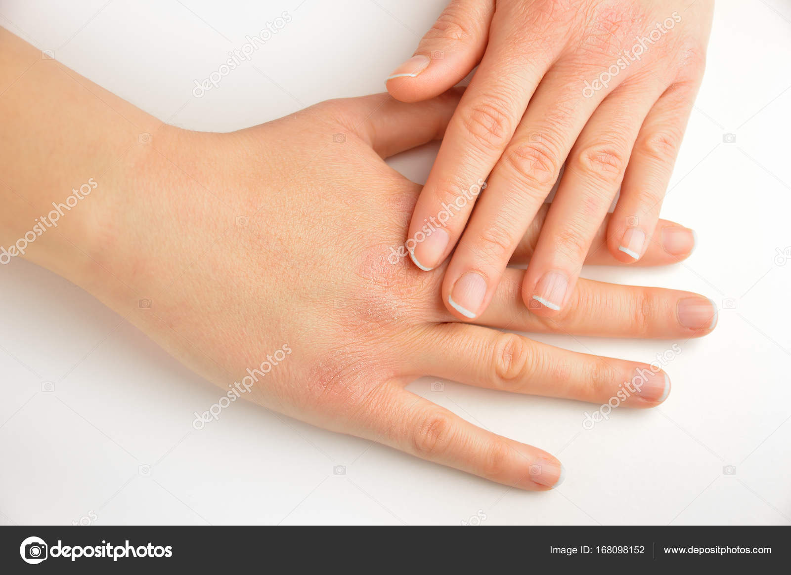 Hands touching with dry skin — Stock Photo © cunaplus #168098152