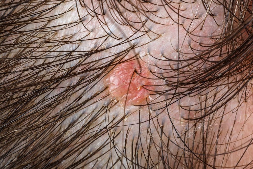 Fotos de Nevus sebaceus en el cuero cabelludo - Imagen de © obencem ...