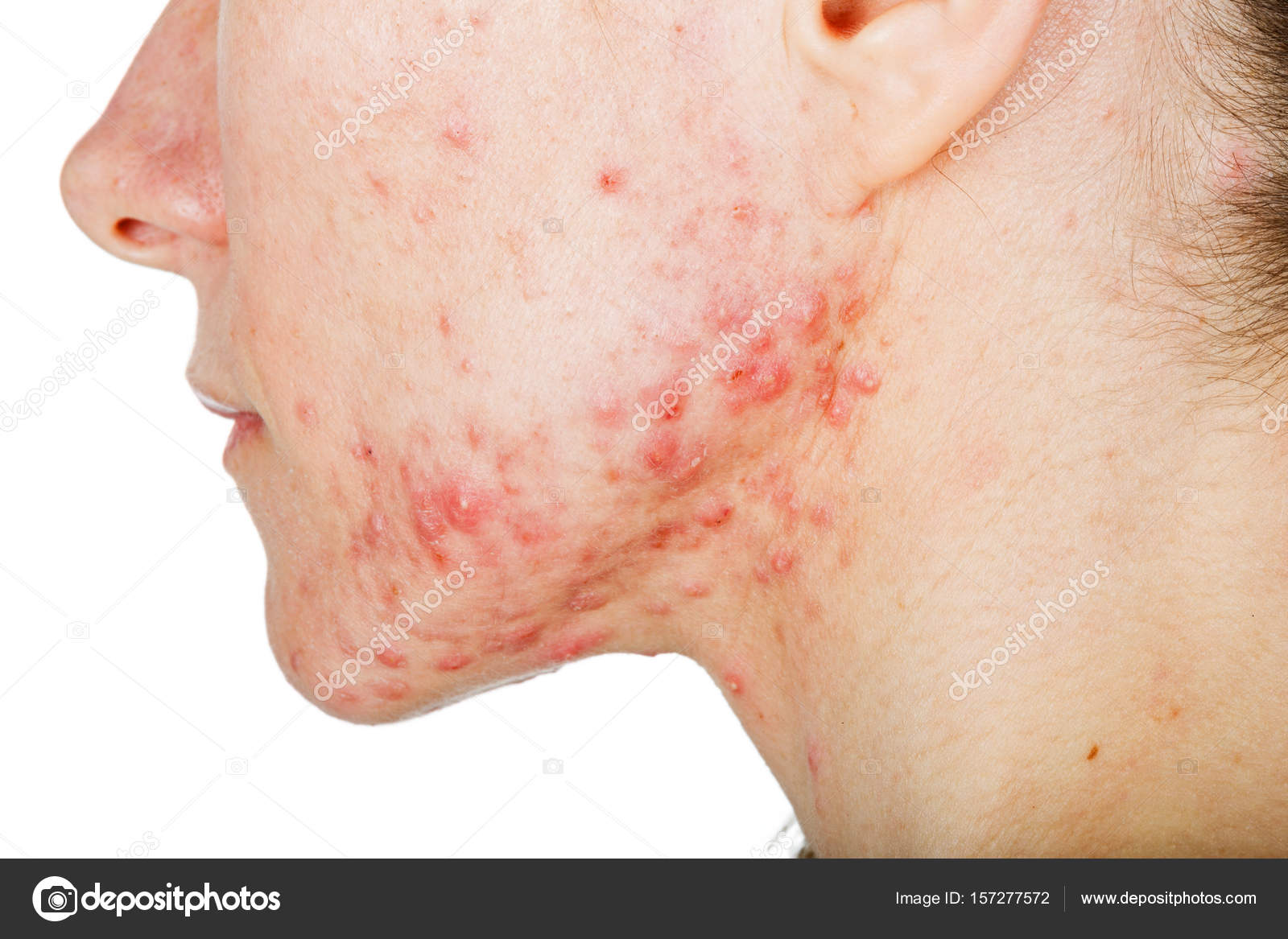 Chica joven con problemas de piel: fotografía de stock © obencem ...