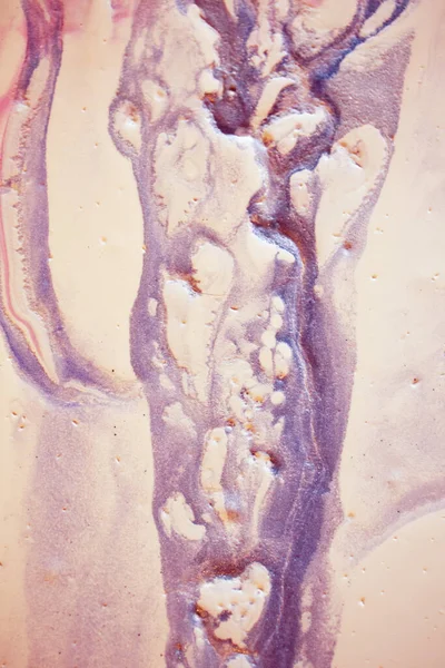 Solitary bone lesions Stock Photos, Royalty Free Solitary bone lesions ...