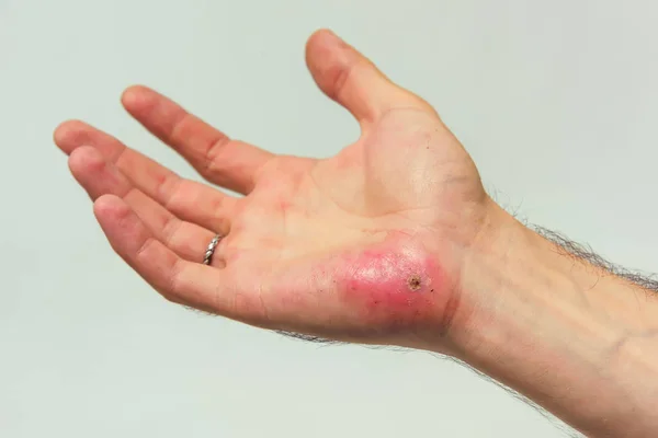 Skin injury Stock Photos, Royalty Free Skin injury Images | Depositphotos