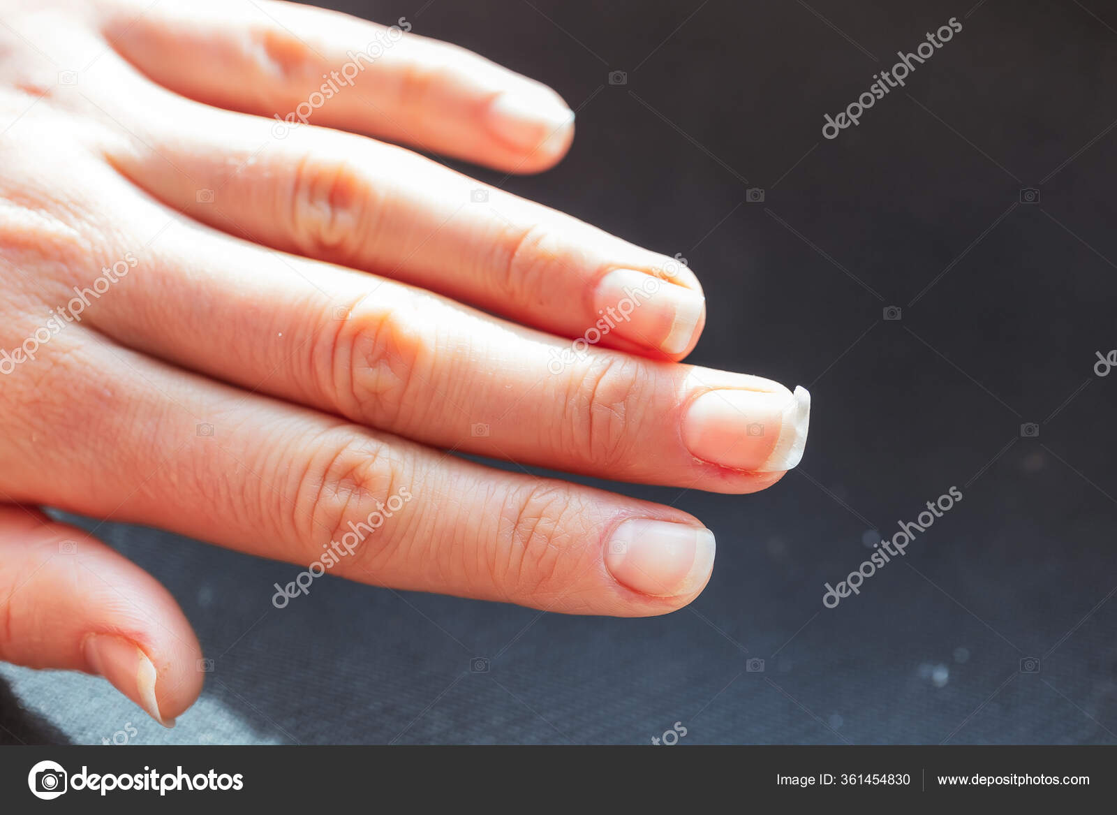 Broken Fingernail Spoiled Manicure Hand Brittle Nails Stock Photo by ...