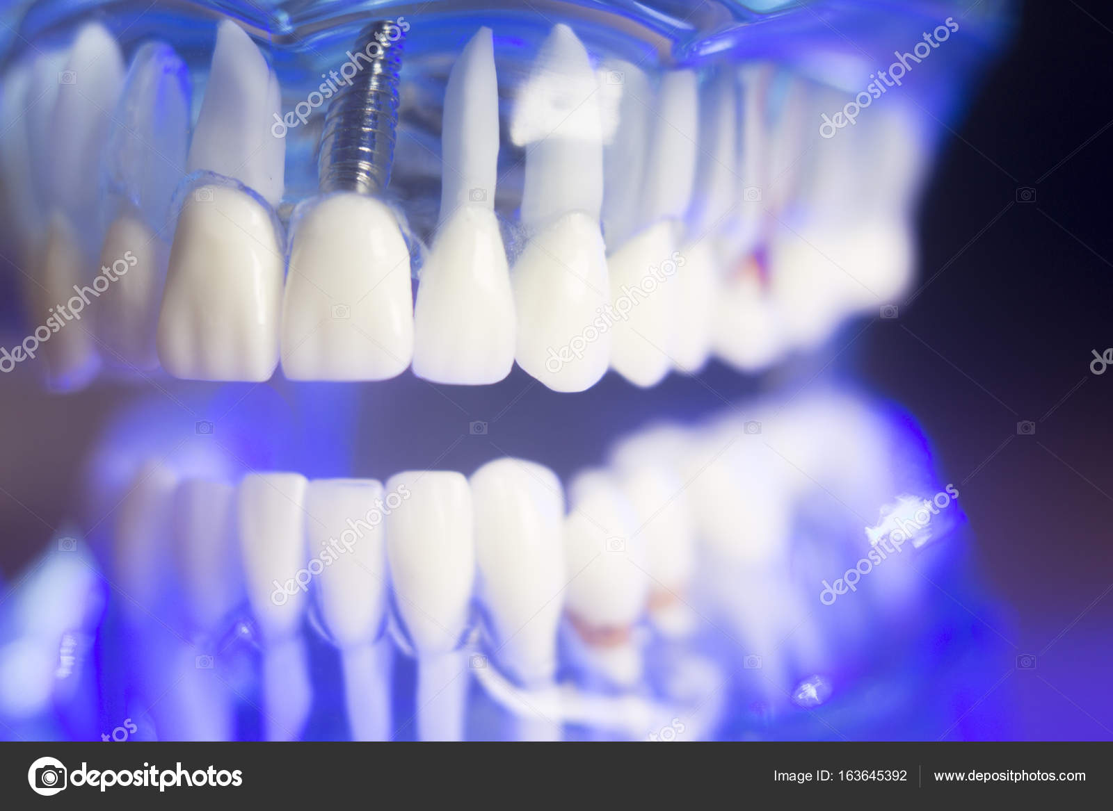 Dental alignment teeth model Stock Photo by ©edwardolive 163645392