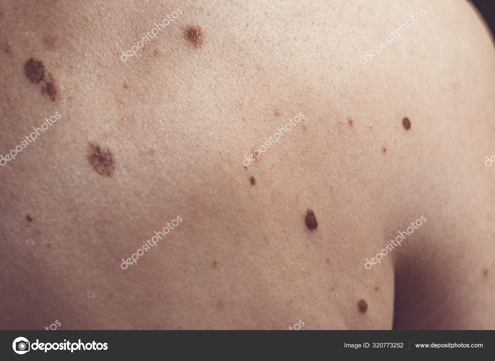 Nevus melanocítico, algunos de ellos displásicos o atípicos, en un ...