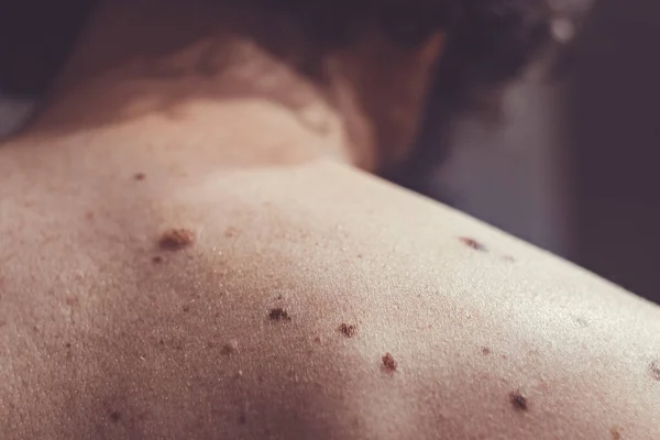 Nevus melanocítico, algunos de ellos displásicos o atípicos, en un ...
