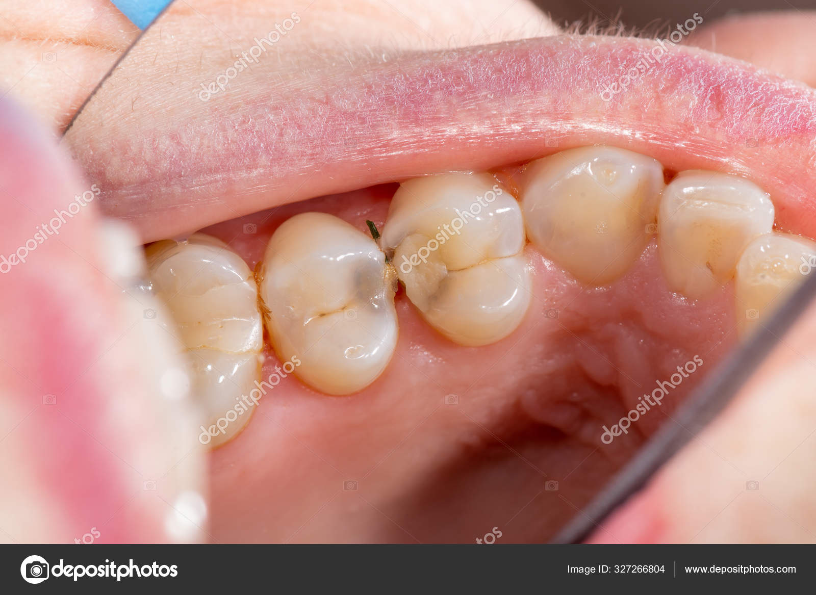 Caries and tooth disease. Filling with a dental composite photop Stock ...