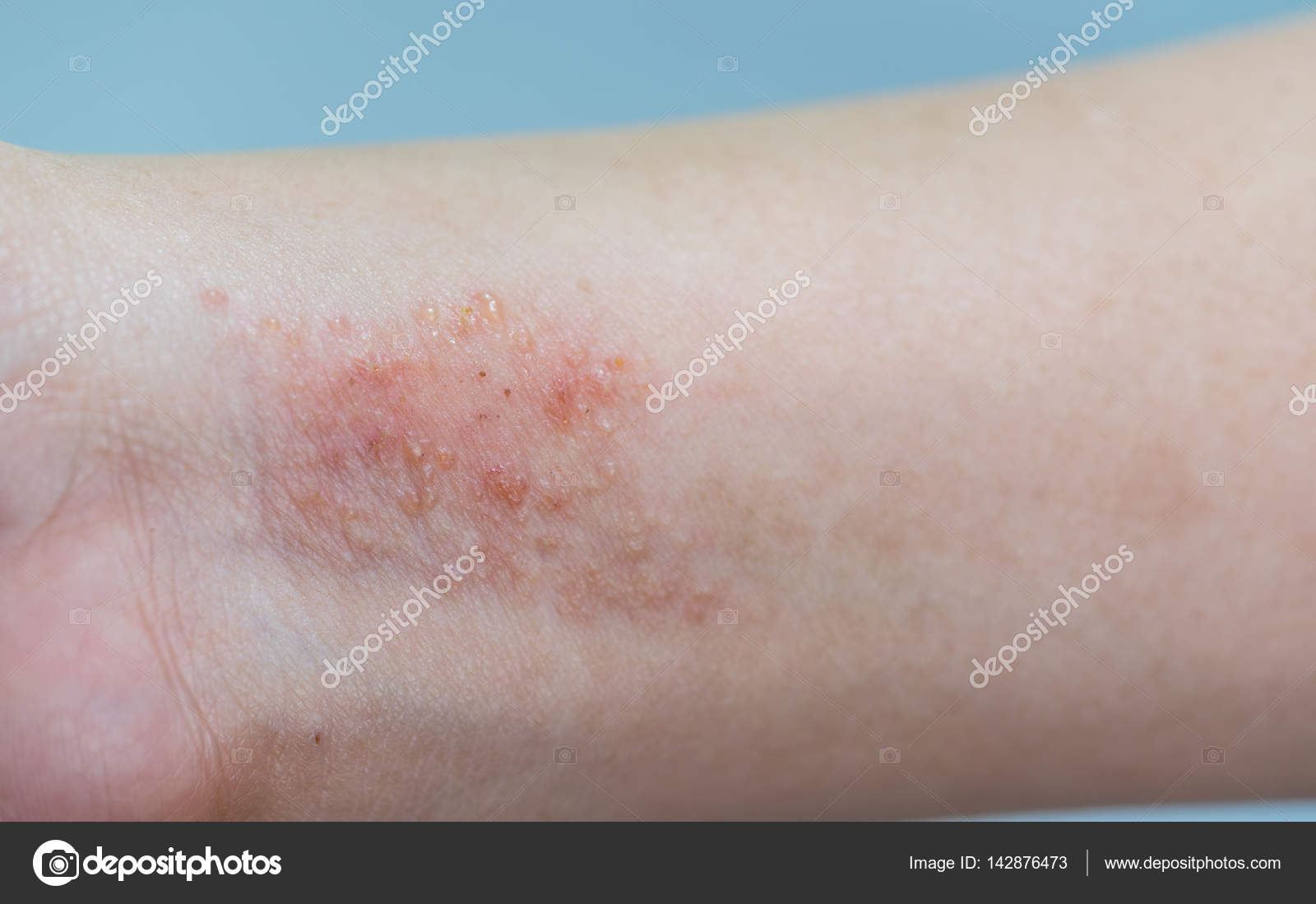 Eczema Atopic Dermatitis Symptom Skin Close Up Skin With 43 Off