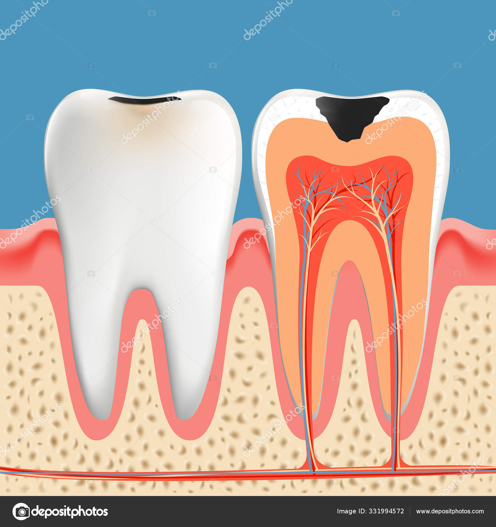 Affiche sur l'anatomie de la carie dentaire. Émail et caries de dentine — Image vectorielle ...