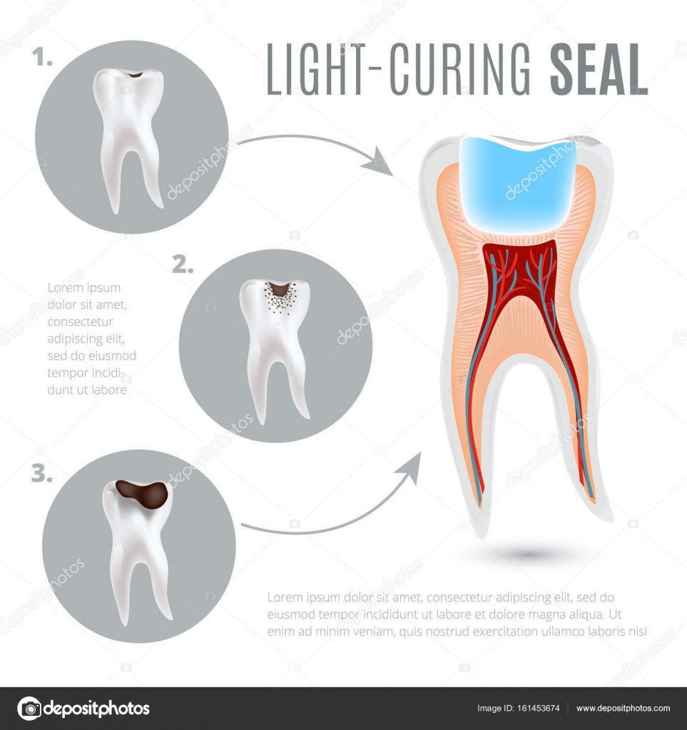 Realistic medical poster with stages of tooth decay and light-curing ...