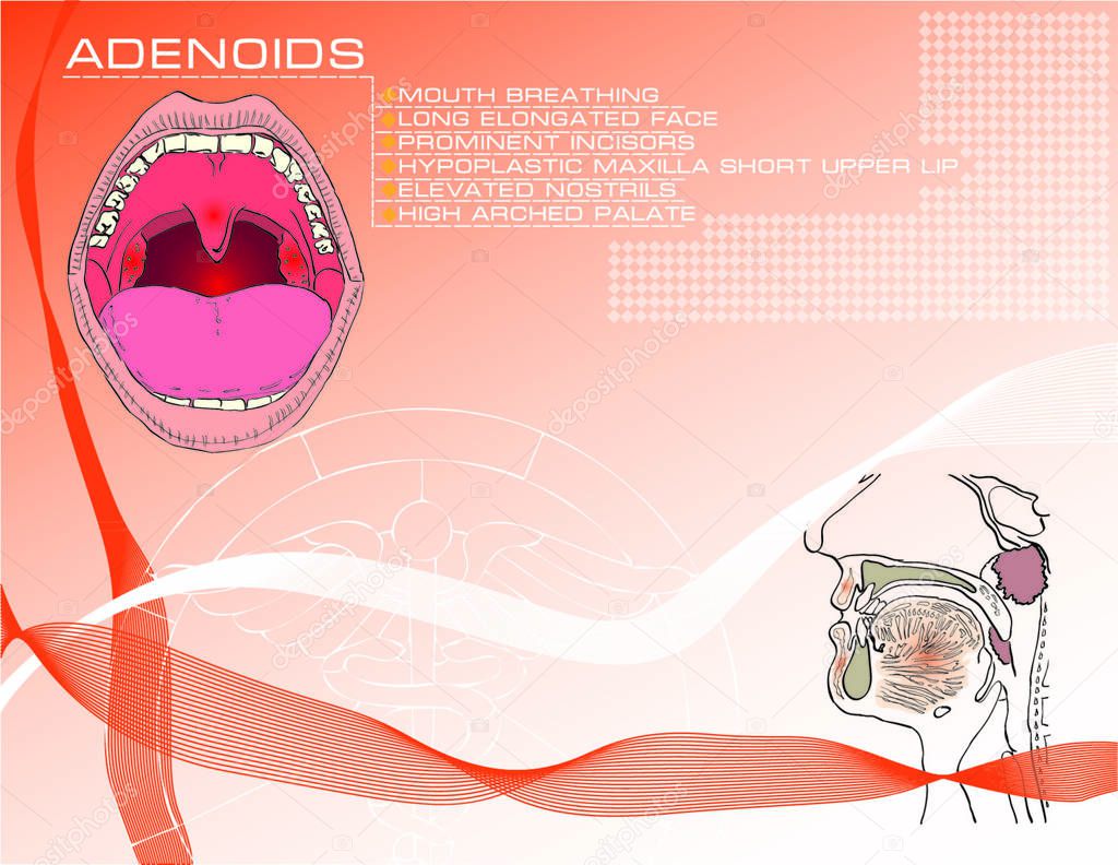 Antecedentes de dibujos animados sobre temas médicos en adenoides con ...