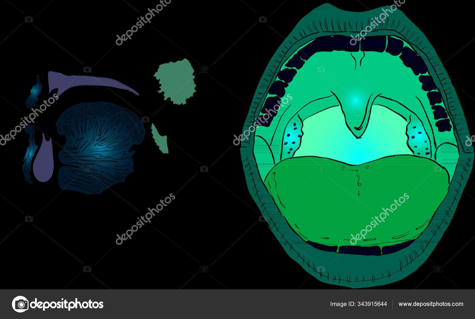 Vector Illustration Disease Adenoids Affected Agencies Stock Vector ...
