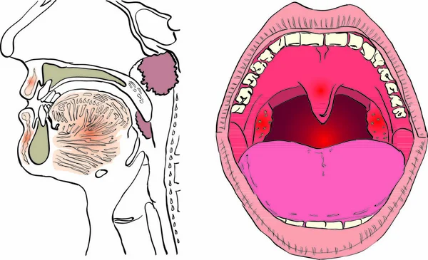 17 Tonsils and adenoids Vector Images, Tonsils and adenoids ...