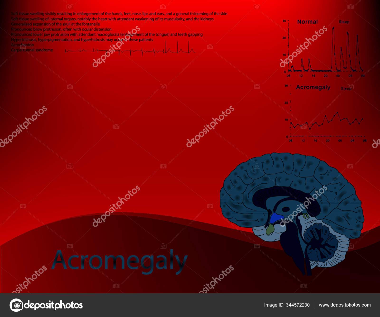 Acromegaly Disease Vector Background Pattern Lesions Brain Charts Stock ...