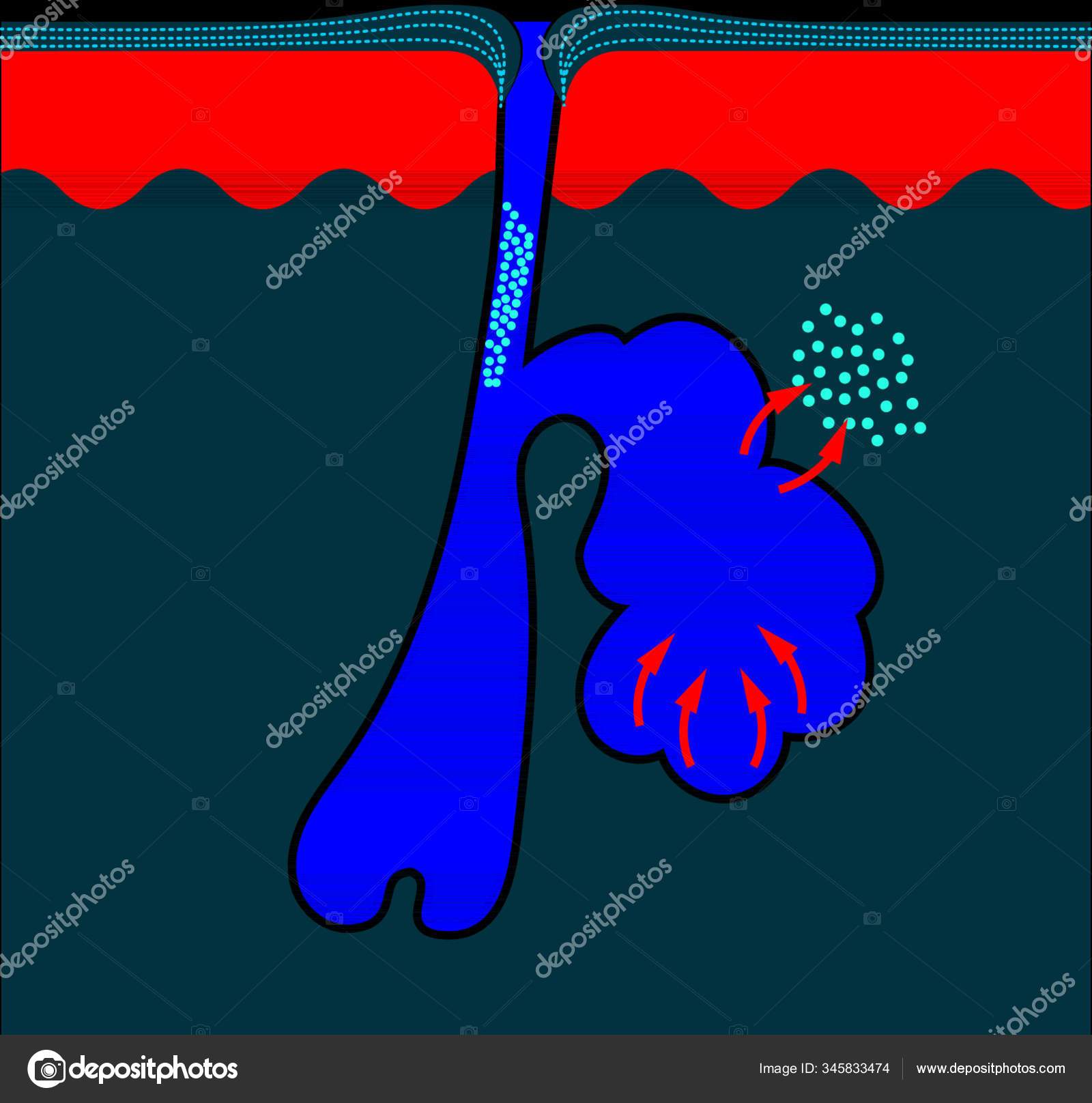 Pathogenic Factors Acne Inflammation Process Increased Secretion Sebum ...