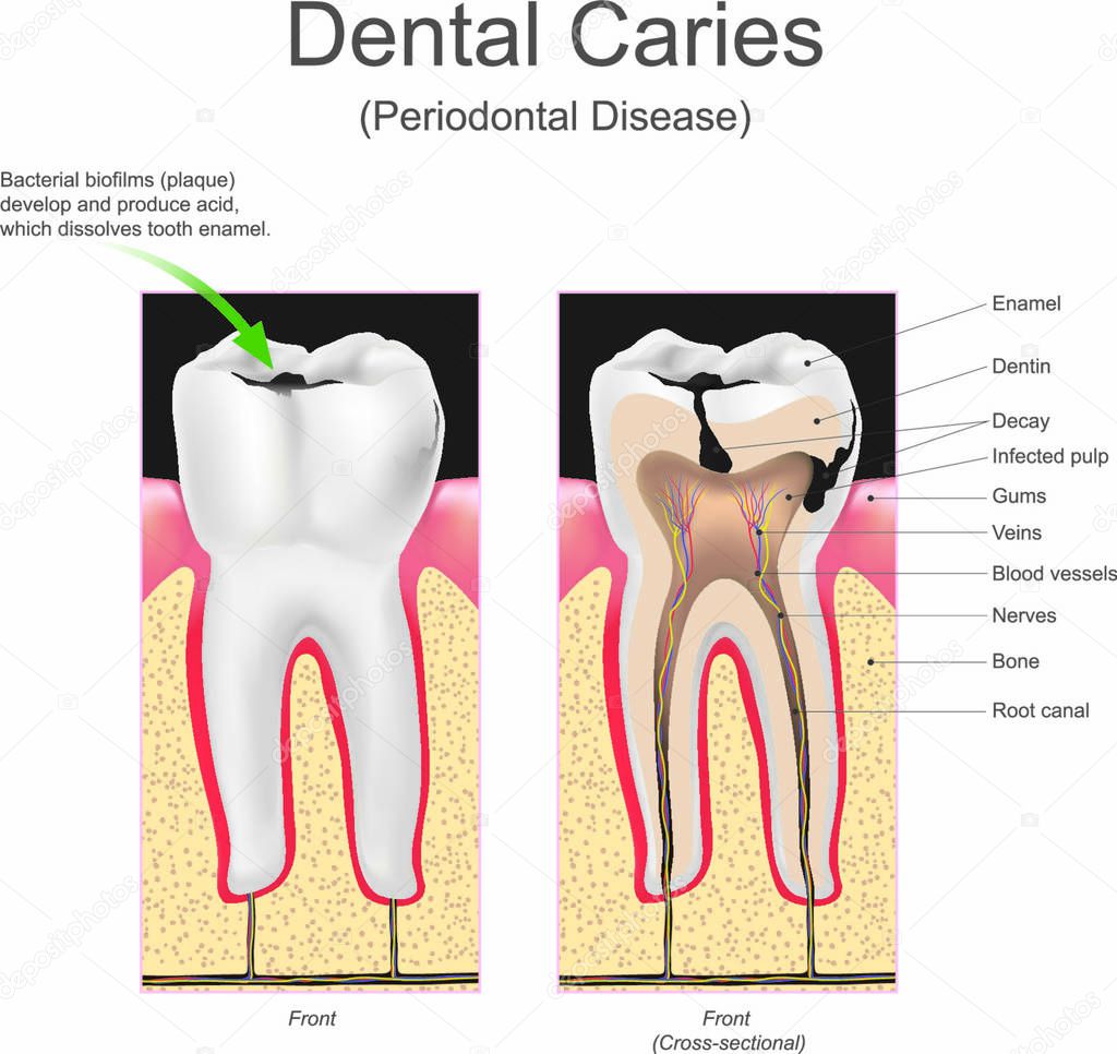 La caries dental es el término científico para caries o caries dental ...