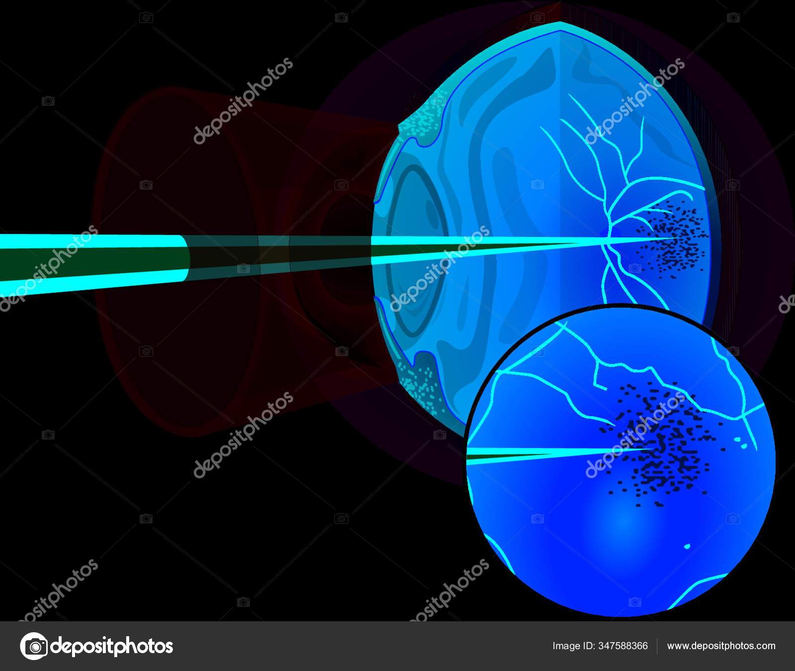 Laser Eye Surgerylaser Eye Surgery Stock Vector Image by ©YAYImages ...