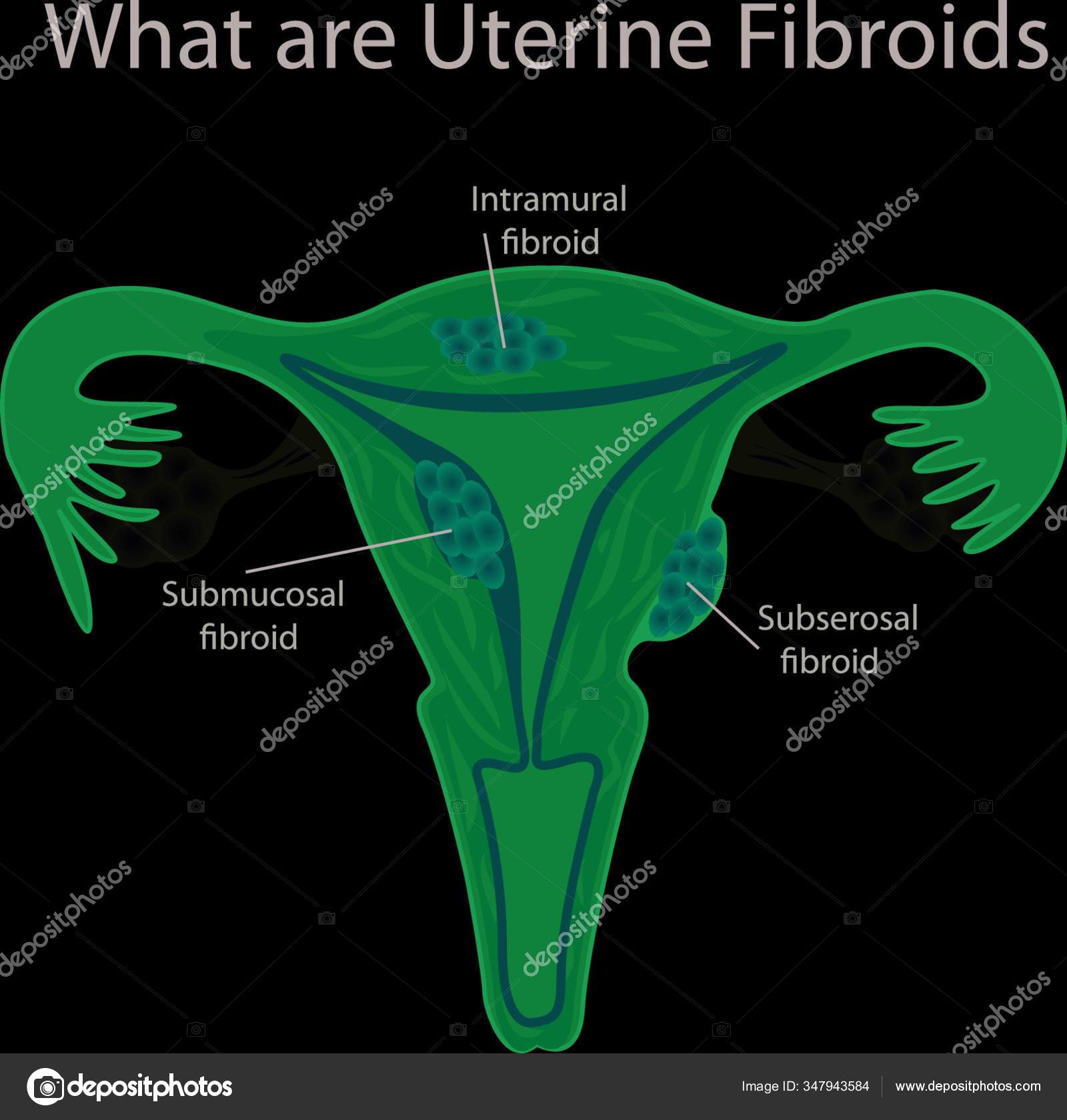 Tipos Fibromas Uterinos Ilustración Vectorial Sobre Fondo Blanco ...