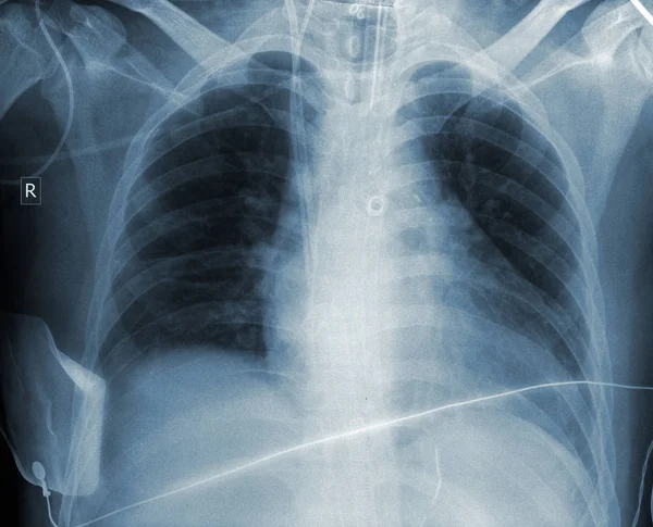 X-ray image of the patient after heart surgery — Stock Photo © sudok1 ...