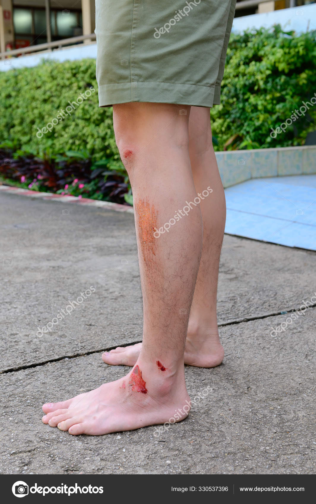 Human Legs Fresh Wound Abrasion Accident — Stock Photo © brostock01 ...