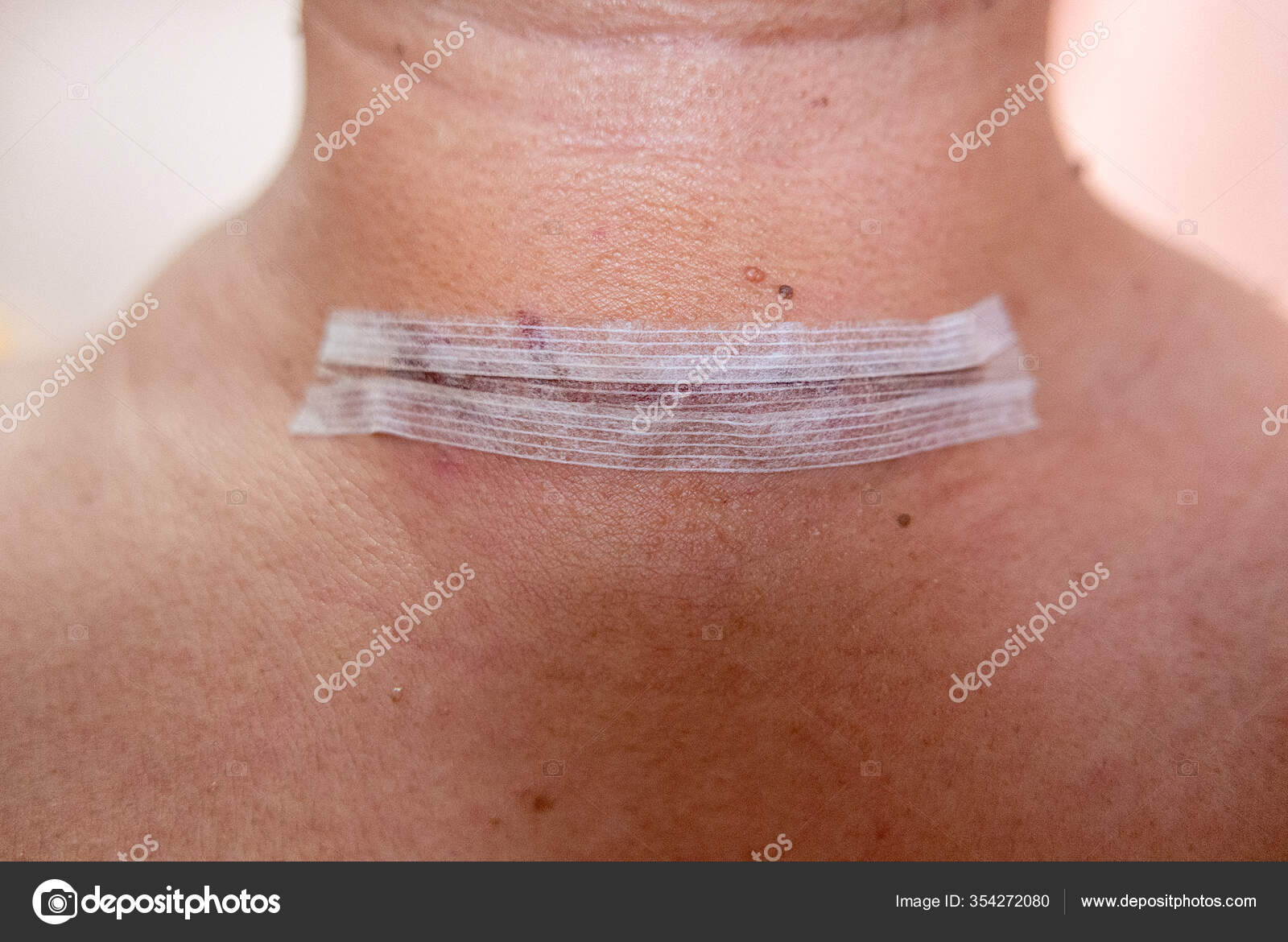 Primer Plano Cicatriz Operación Tiroidea Hombre Con Vendaje Adhesivo ...