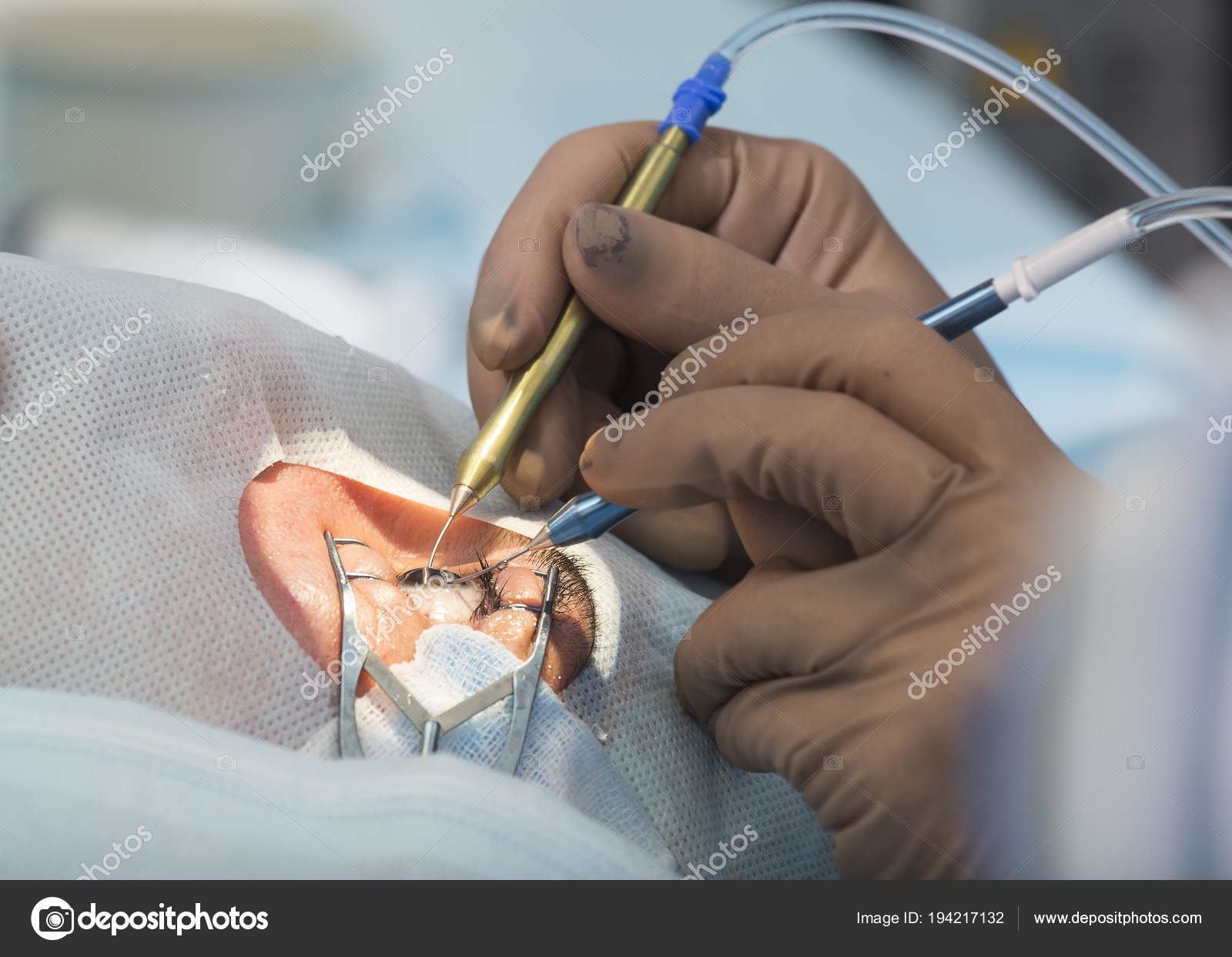 Phacoemulsification, destruction of the opaque lens of the eye b Stock ...