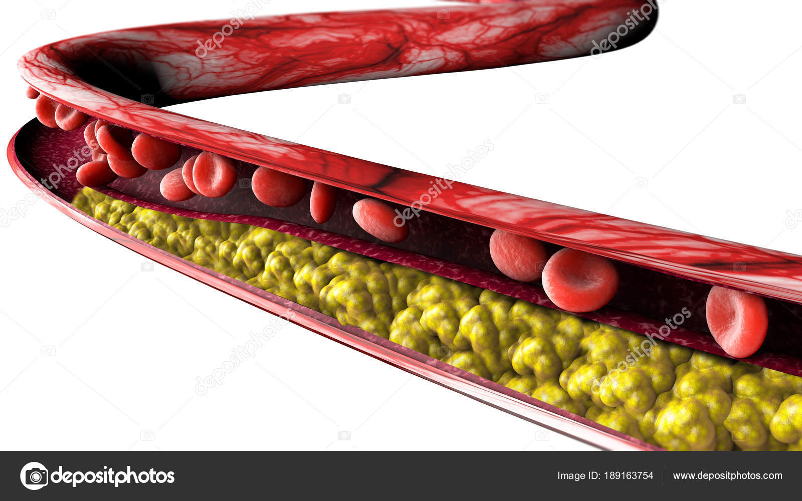 Cholesterol Formation Fat Artery Vein Heart Narrowing Vein Fat ...
