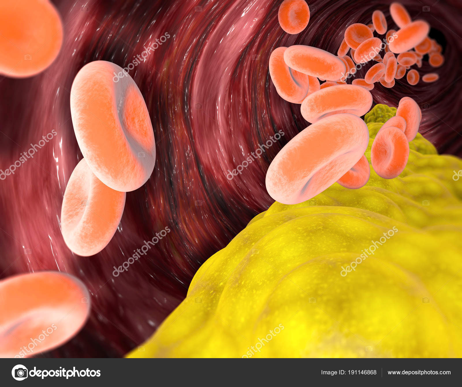 Cholesterol Formation Fat Artery Vein Heart Narrowing Vein Fat ...