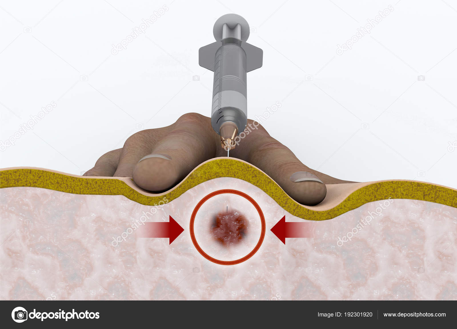 Trigger Point Injection Outpatient Procedure Designed Reduce Relieve ...