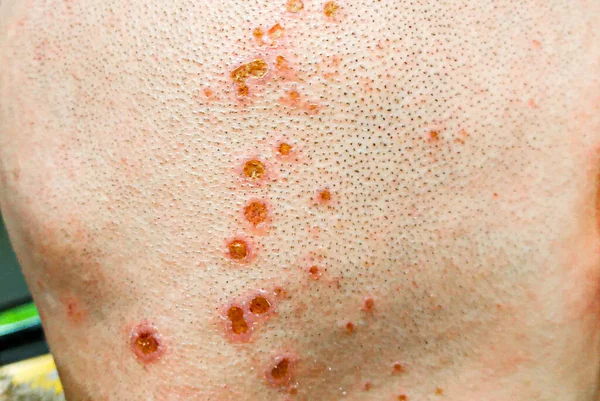 Black death rash Stock Photos, Royalty Free Black death rash Images ...