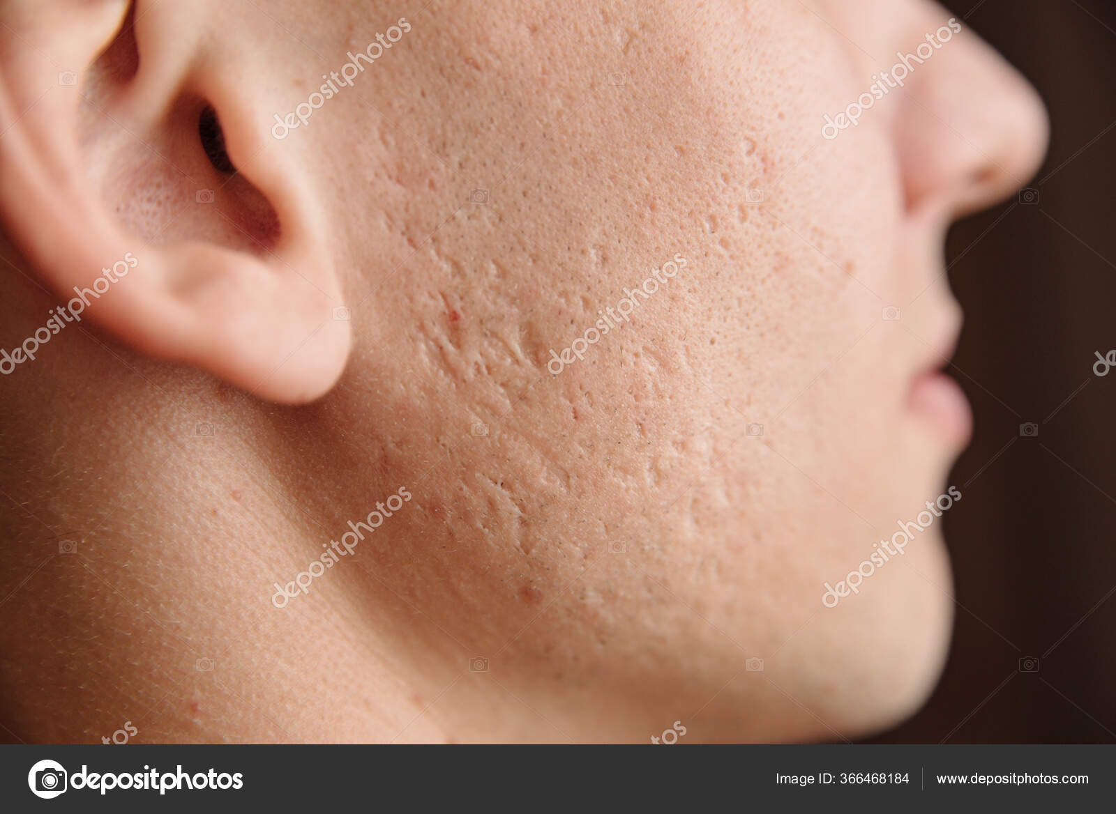 Close Problem Skin Deep Acne Scars Young Man's Cheek — Stock Photo © bo ...