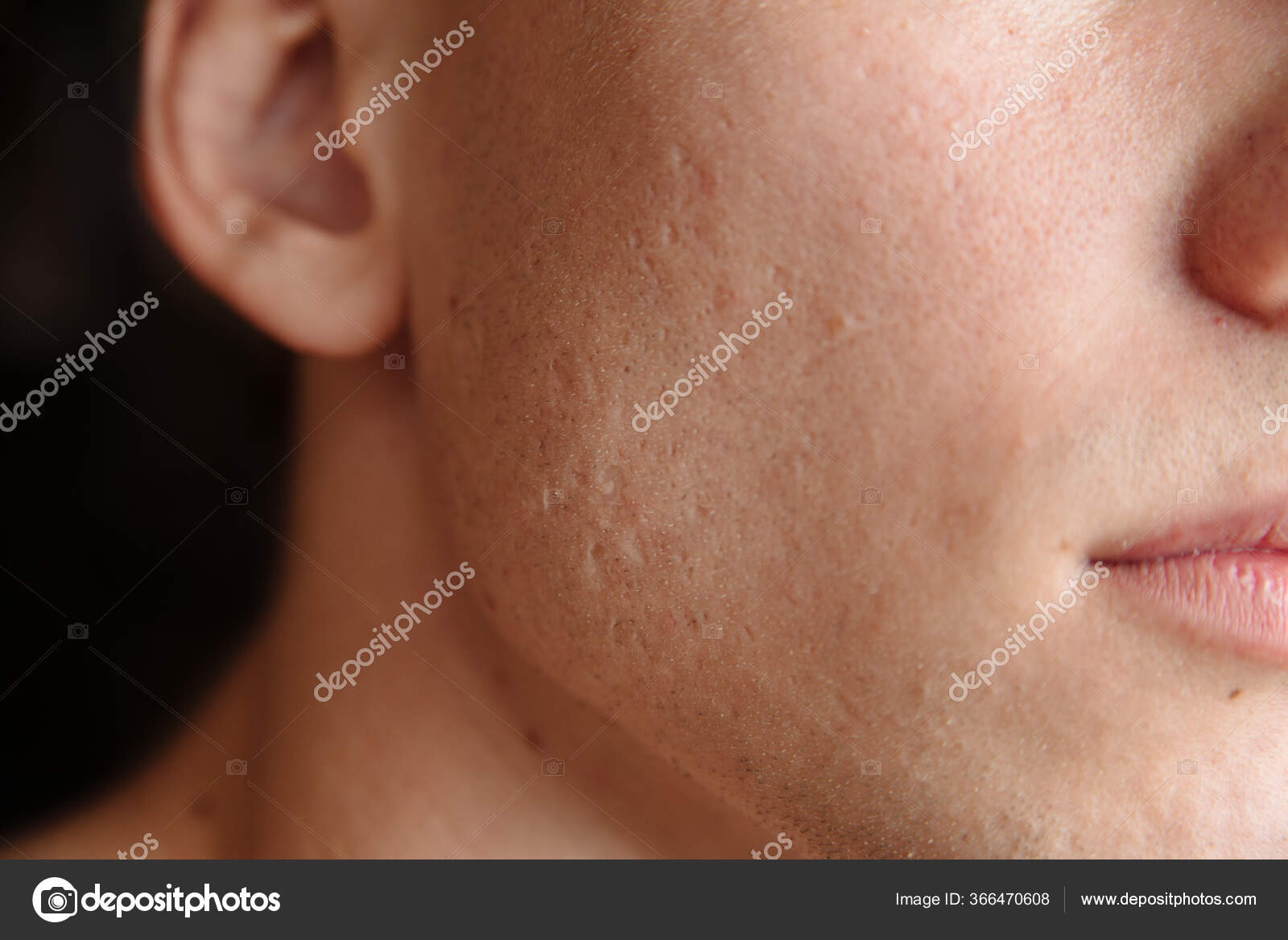 Close Problem Skin Deep Acne Scars Young Man's Cheek — Stock Photo © bo ...